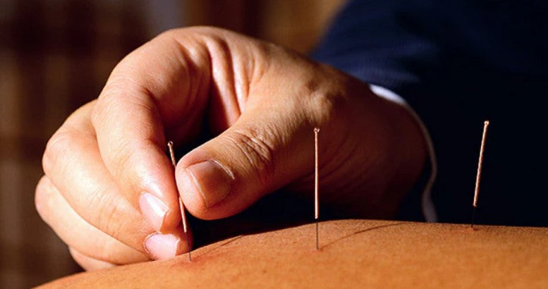 What is acupuncture? – AcupunctureShop