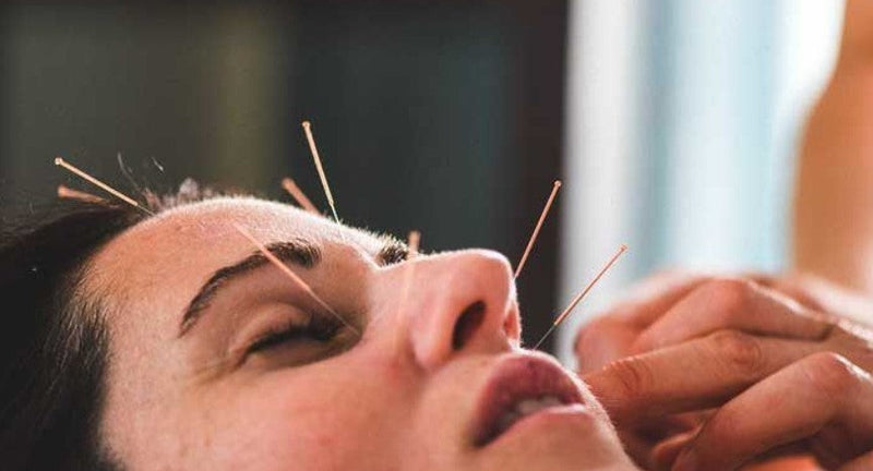 Acupuncture's Therapeutic effect – AcupunctureShop